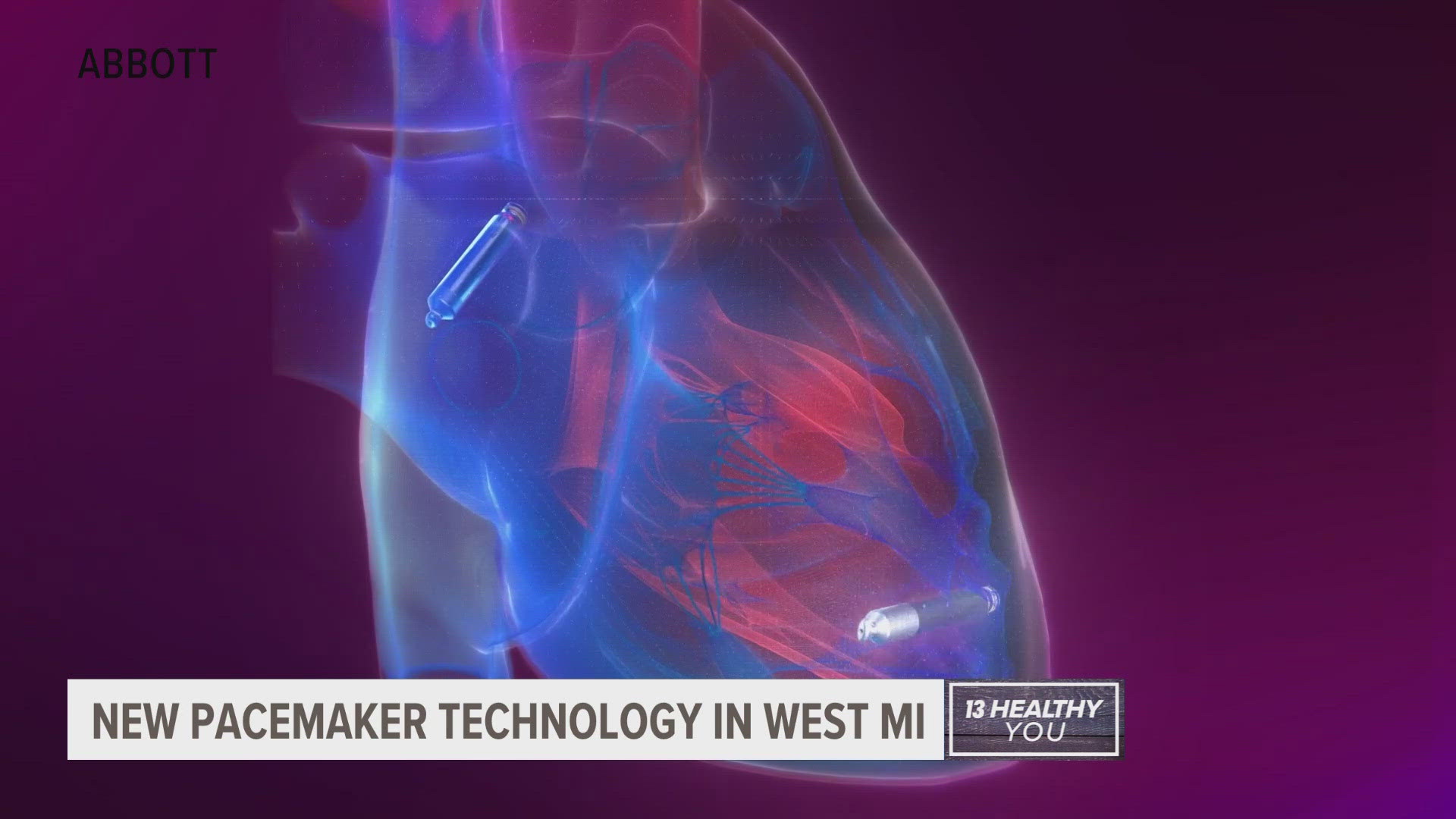 West MI hospital implants new pacemaker technology