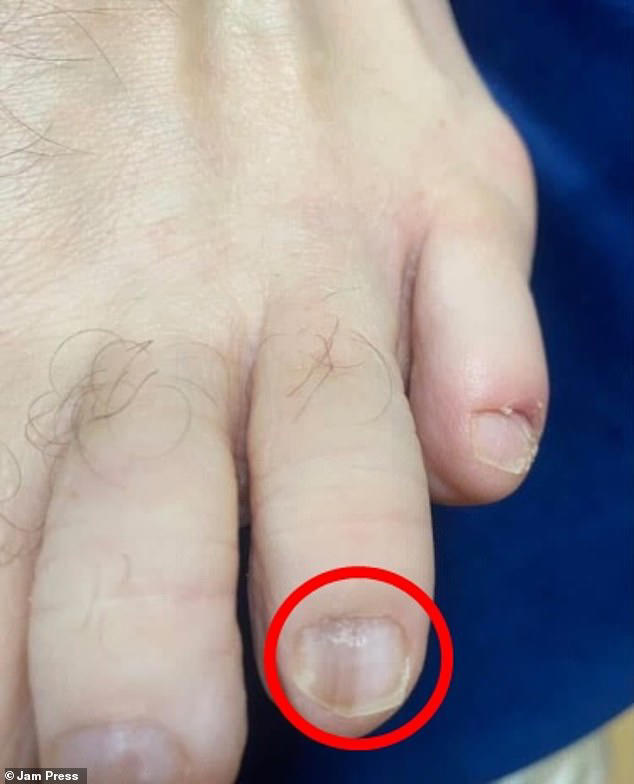 Subtle change to man's toenail that was sign of deadliest skin cancer