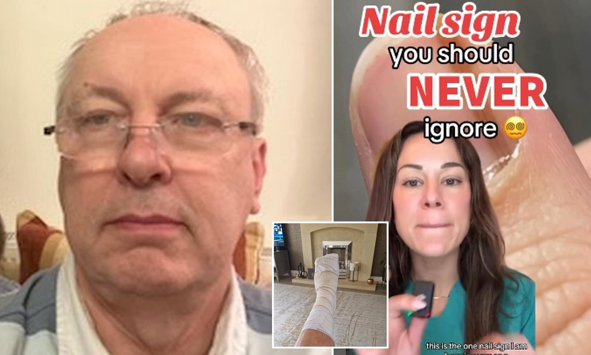 Subtle change to man's toenail that was sign of deadliest skin cancer