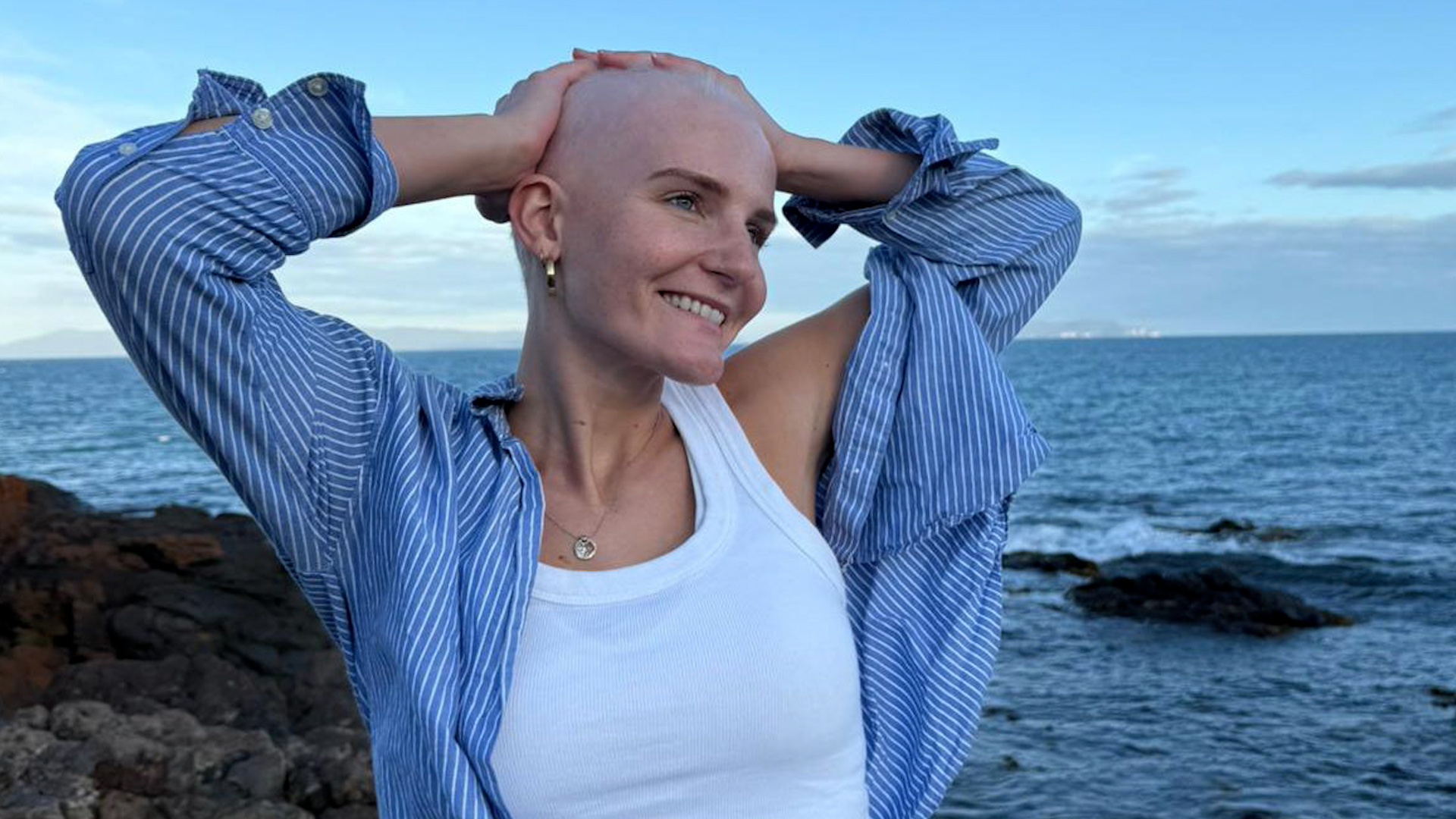 "I'm embracing my alopecia - I was diagnosed after my hair fell out in ...