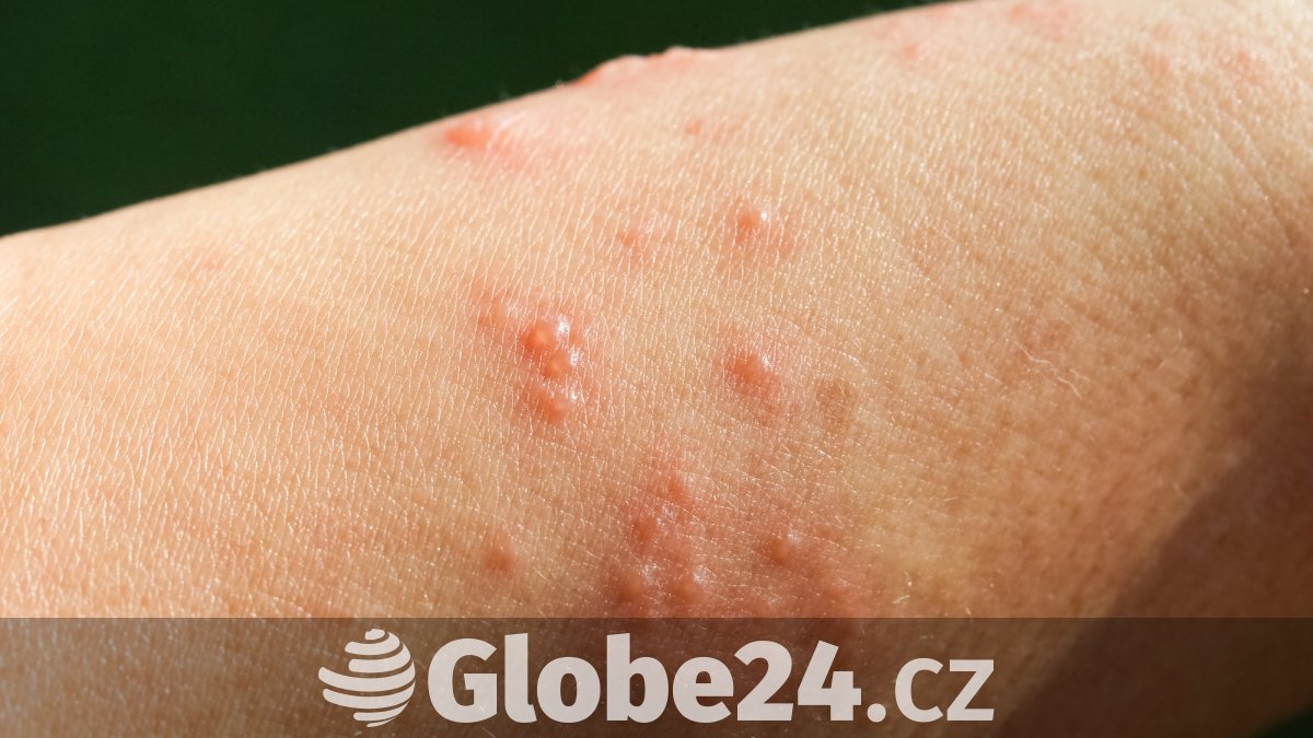 Českem se opět šíří svrab. Co to je a jak s ním bojovat?
