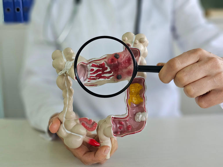 "Je suis gastro-entérologue : voici 4 signes du cancer du côlon à ne ...