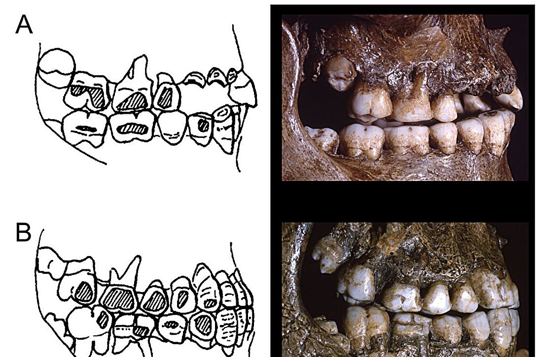 Flat patches on ancient Europeans' teeth reveal possible cheek piercing ...