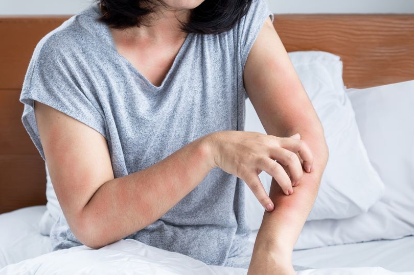 New case of 'more contagious' mpox in UK as NHS issues advice on how to ...