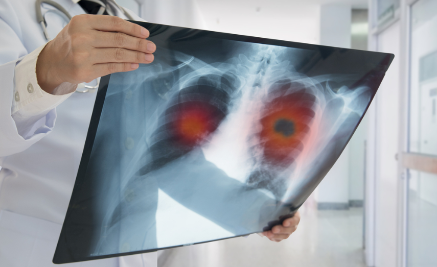 Early Warning Signs of Cancer You Shouldn’t Ignore