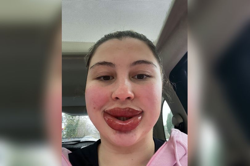 'My lip fillers made me look like a Monsters Inc character, I had to ...