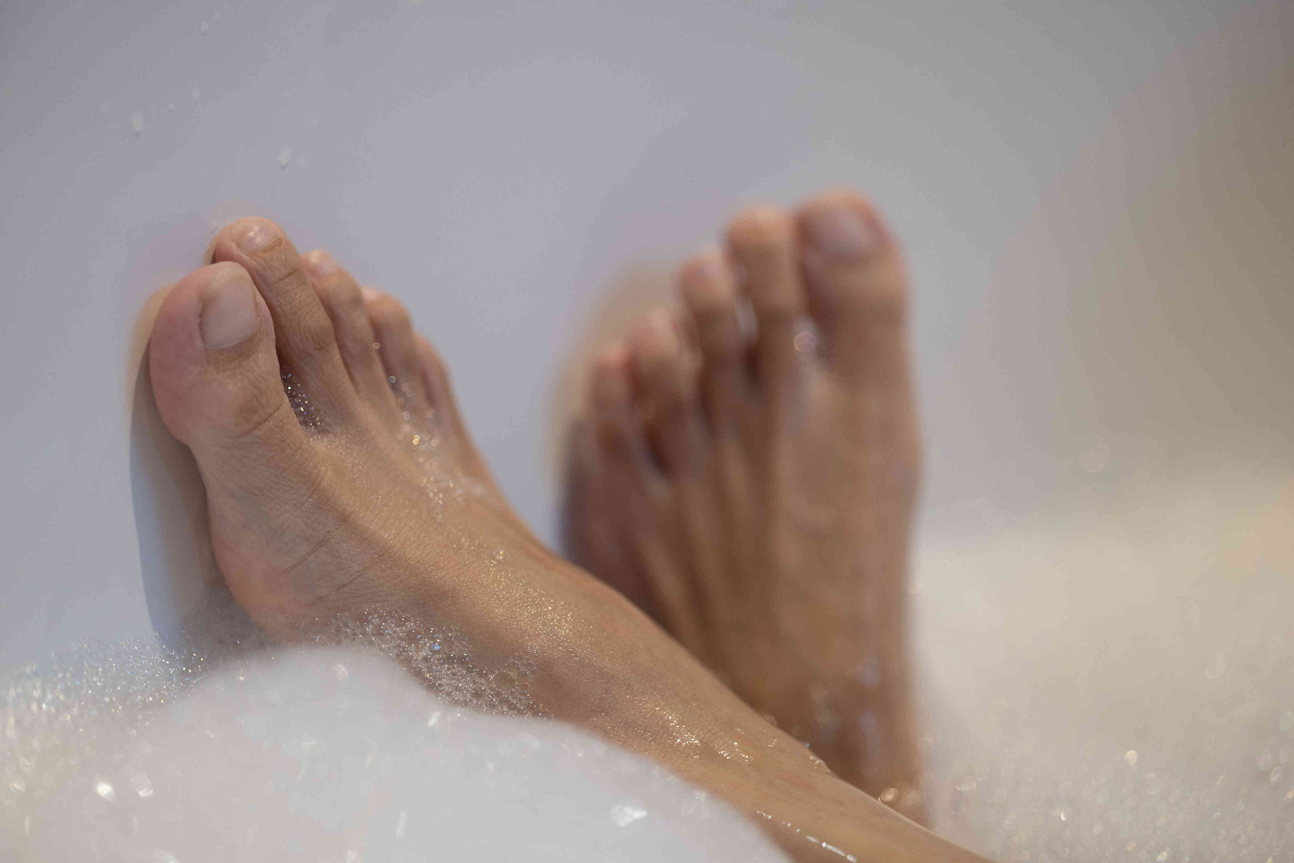Is Pitted Keratolysis the Cause of Your Chronic Foot Odor?
