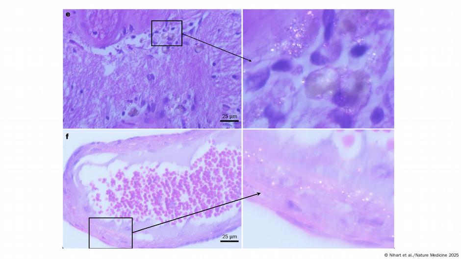 Study finds microplastics in US brains: Are they dangerous?