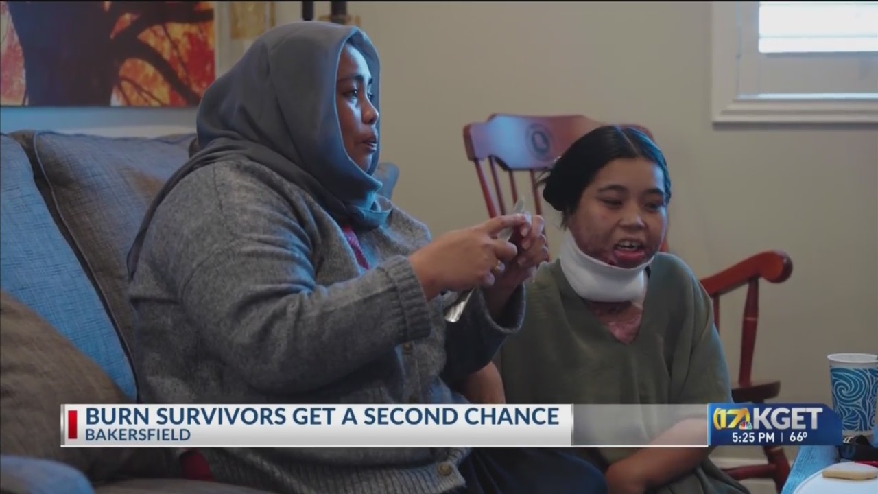 Burn survivors get a second chance