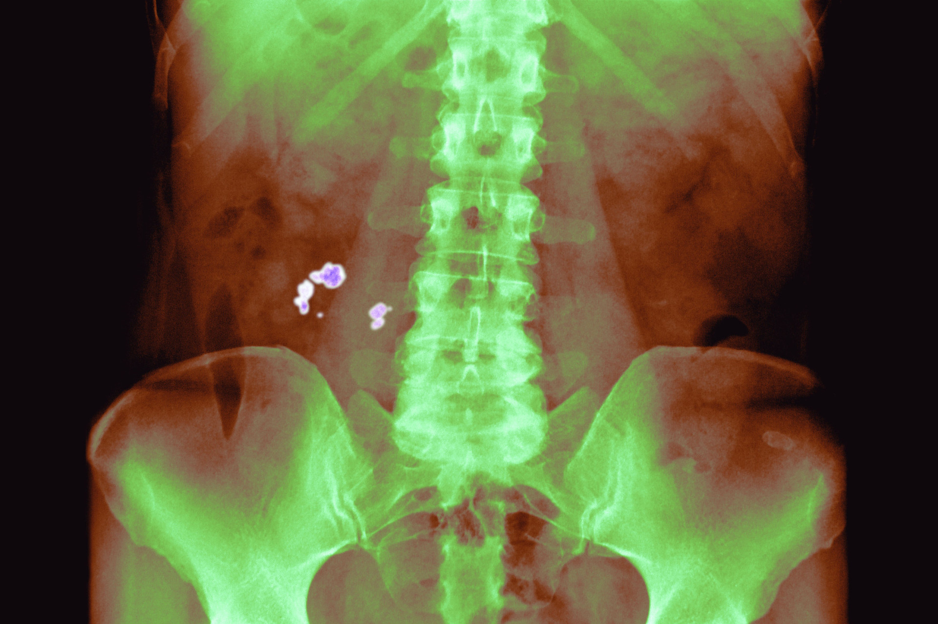 Everything you need to know about kidney stones