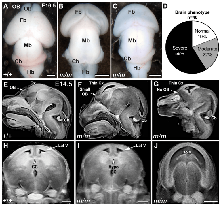 Researchers find genetic link between heart disease and brain development
