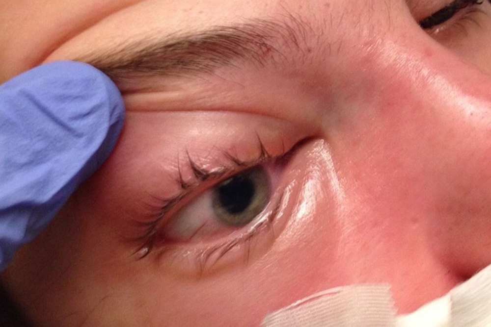 Waspada Infeksi Jamur Hitam, Ini Gejala Mukormikosis