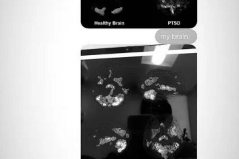 Ariana Grande shocking brain scan reveals brutal impact of years of PTSD