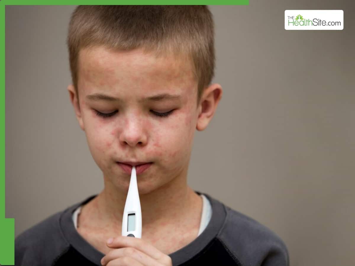 Measles Outbreak In Texas: State Health Services Confirm 24 Cases Among ...