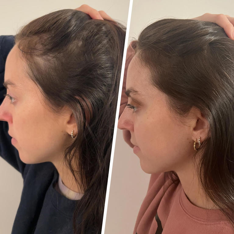 Are there any benefits to red light masks? We asked dermatologists