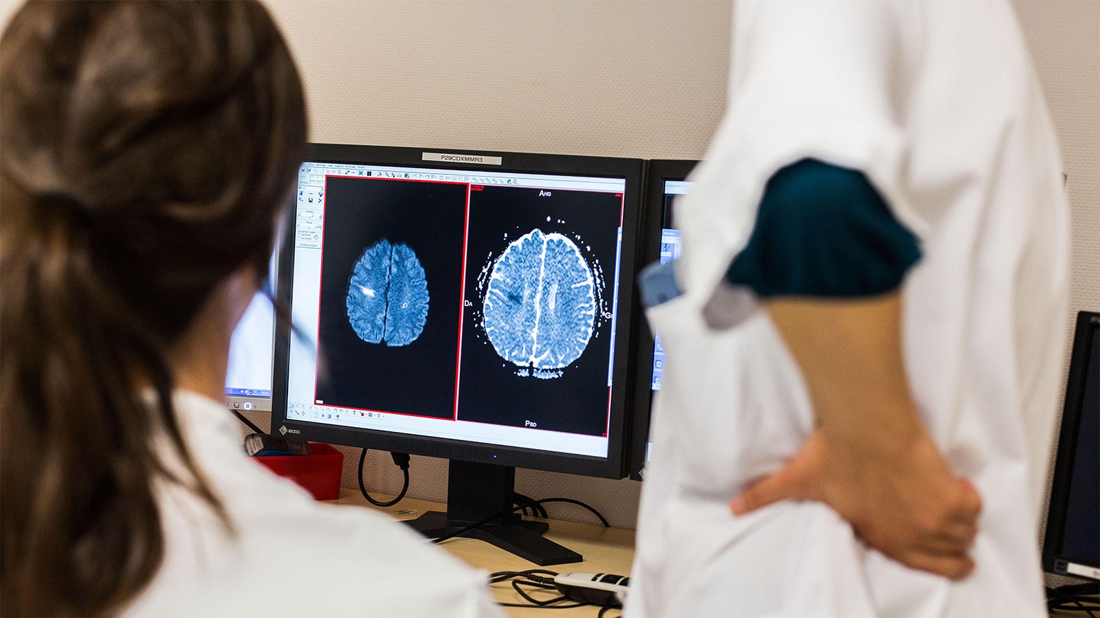 SGLT1/2 Inhibitor Cut Stroke, Heart Attack Risk in Diabetic Kidney Disease