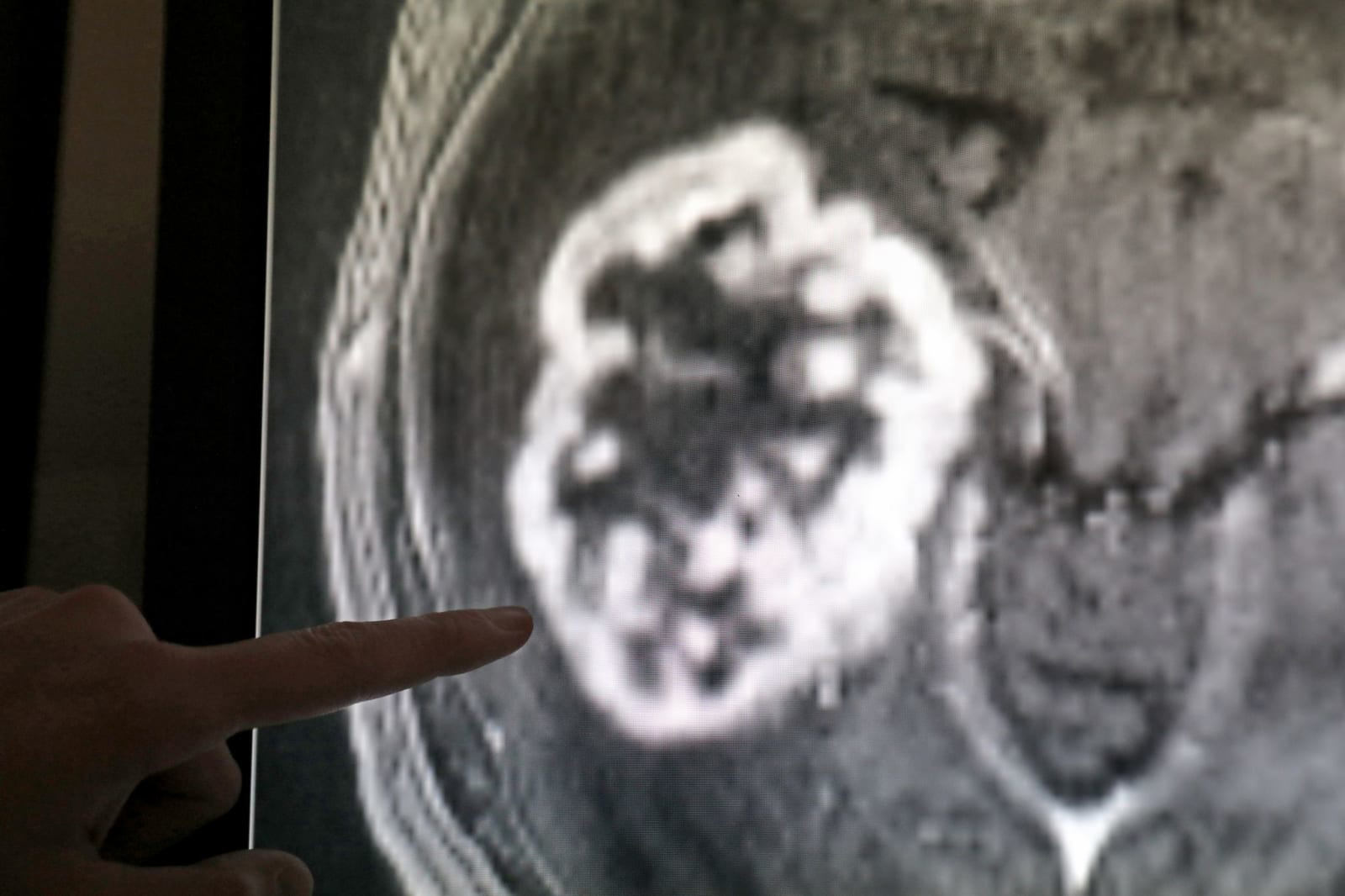 Scientists find way to predict which tumours will become aggressive Scientists find way to predict which tumours will become aggressive