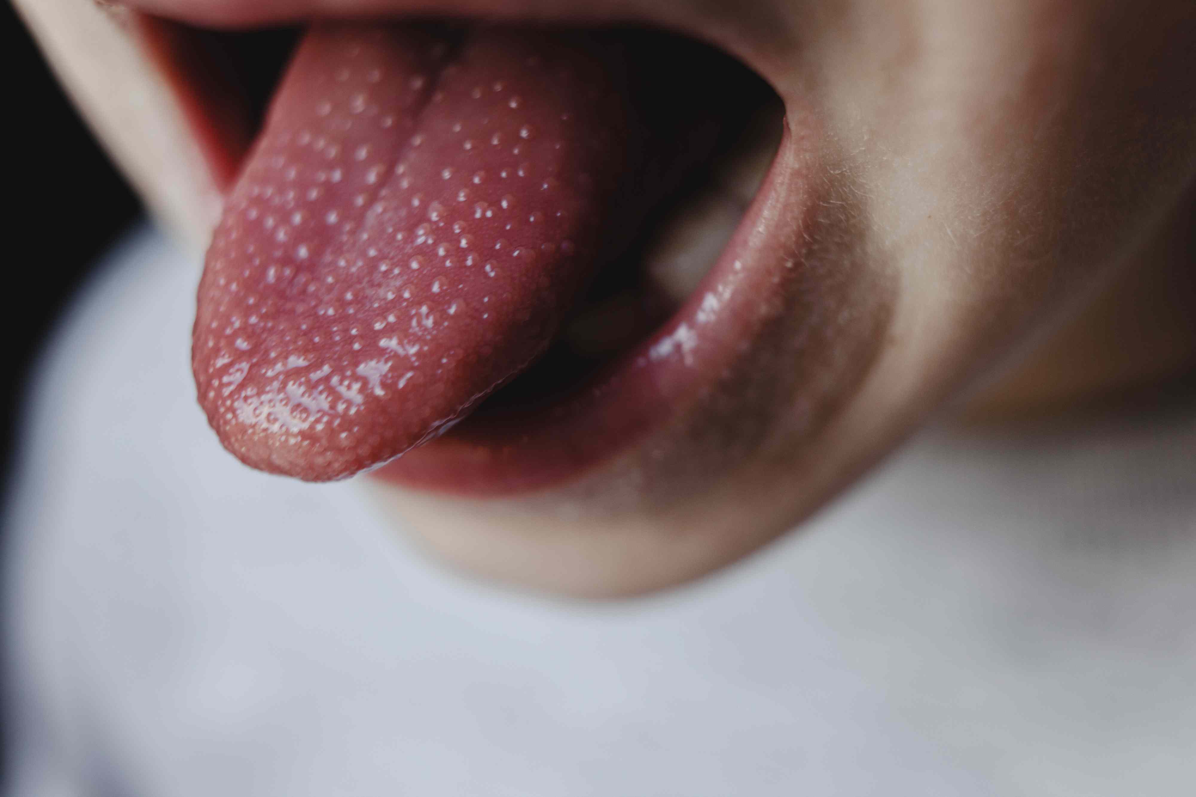 What causes strawberry tongue?