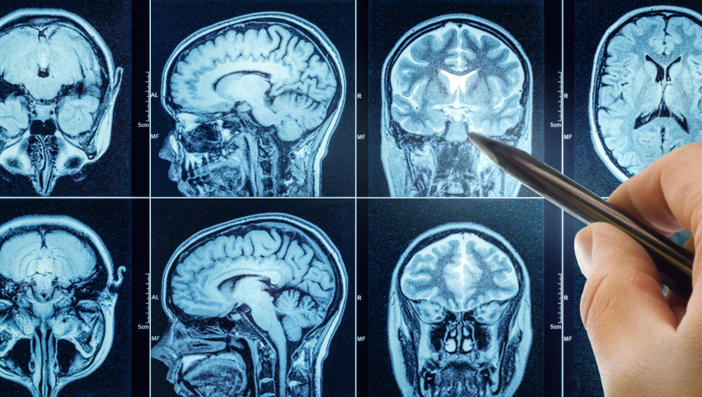 Harvard Neurologist Warns: These Sleep Habits Could Trigger Alzheimer’s