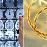 In a Rare Case, a Parasite Has Infected a Womans Brain