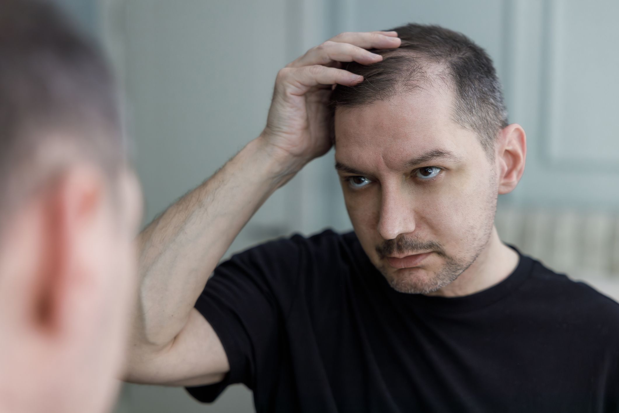 10 Natural Minoxidil Alternatives for Hair Loss