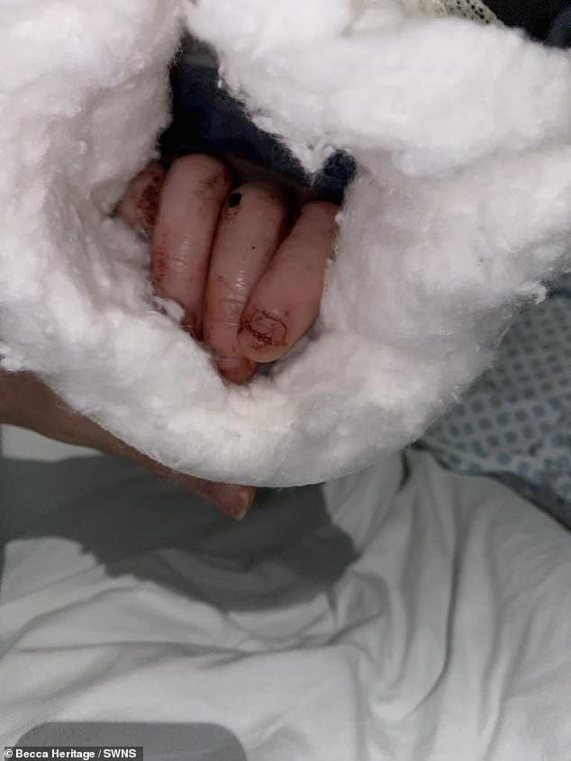 Student had a rare hand transplant to help her become a doctor