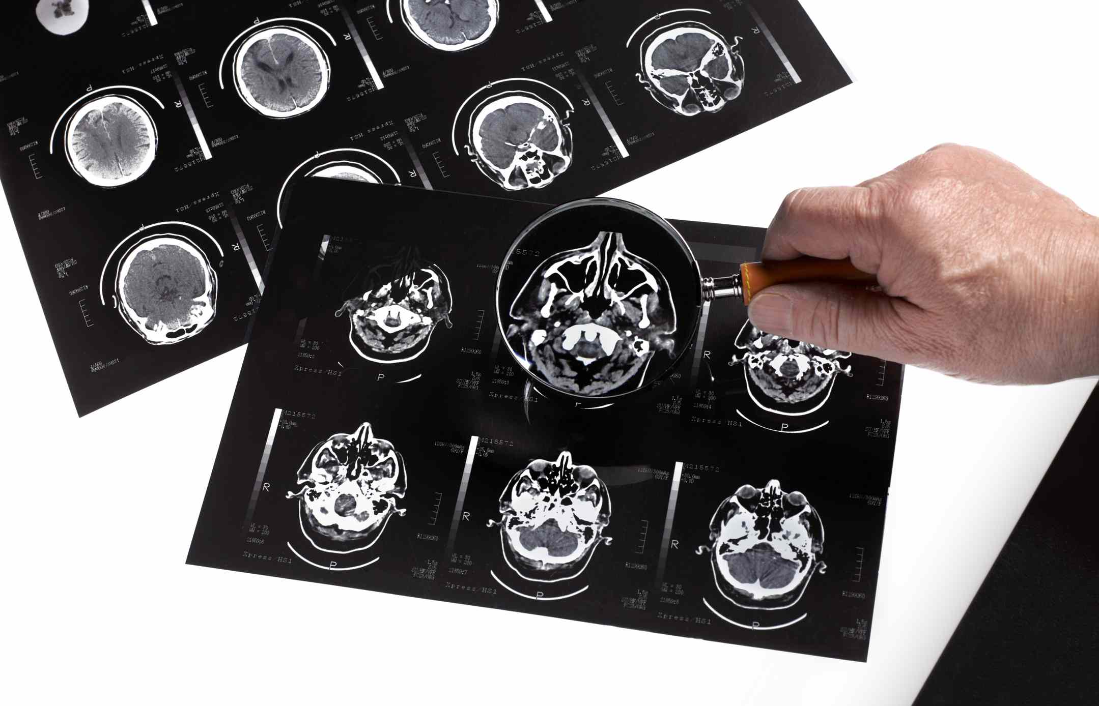 Pick's Disease and How It Differs From Alzheimer's Dementia