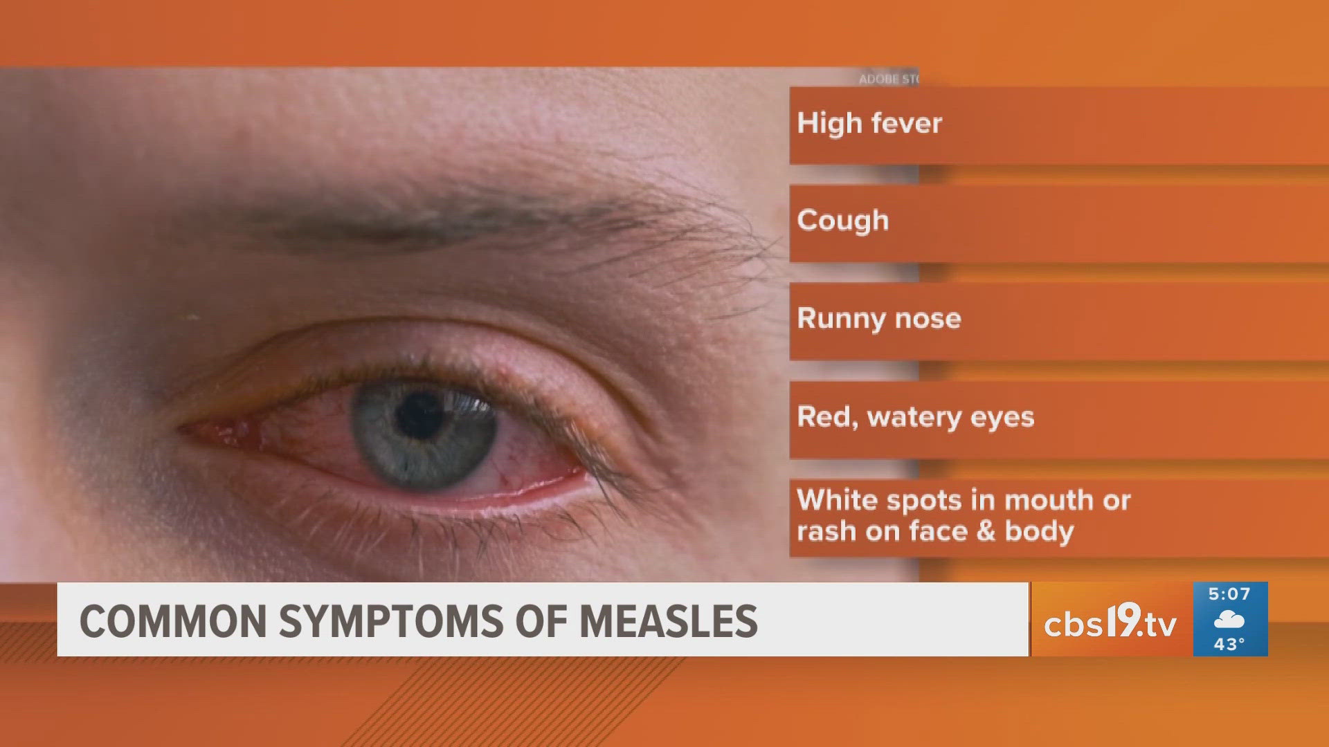 What are the common symptoms of measles?