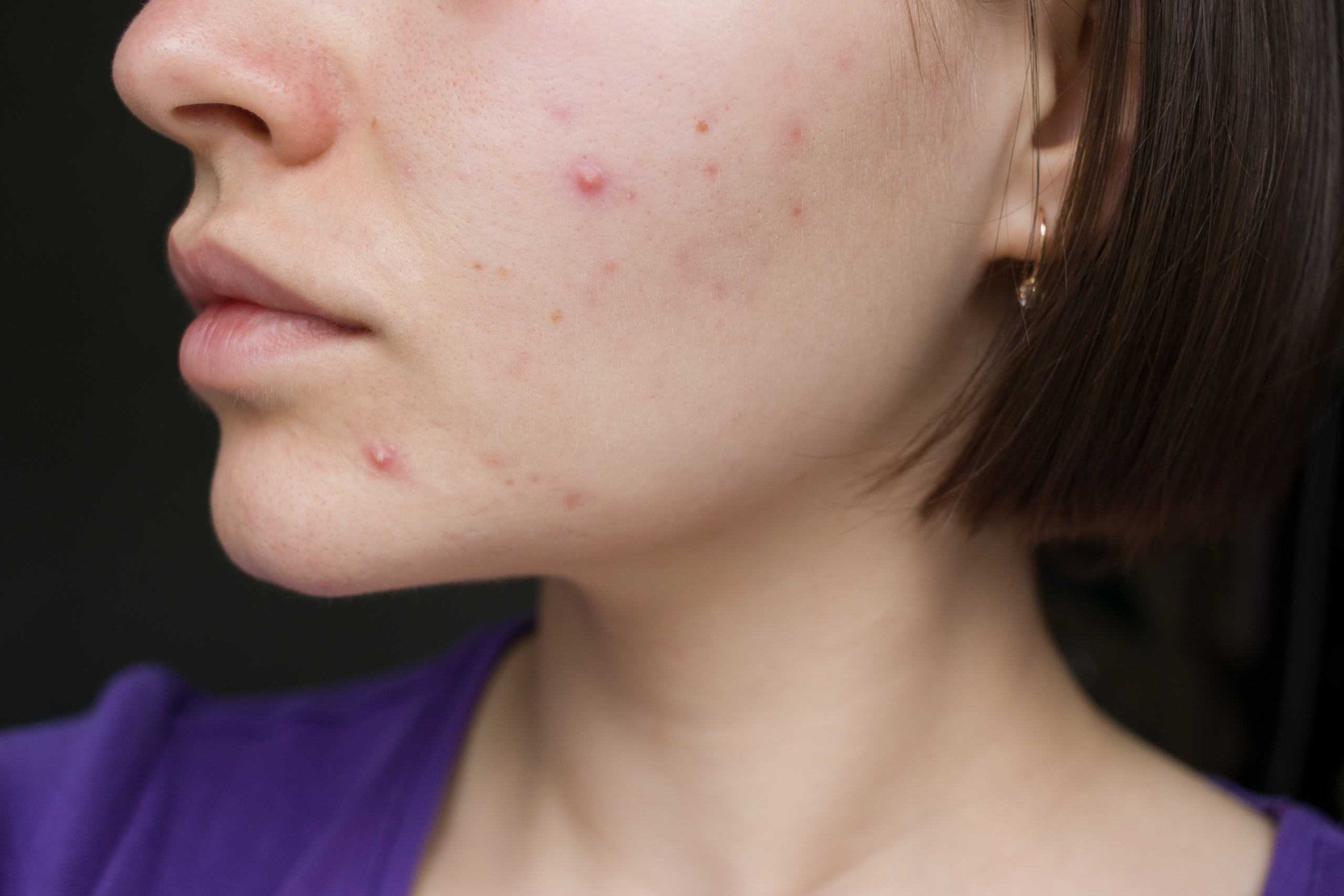 Adult acne: how to prevent, manage, and restore clear skin