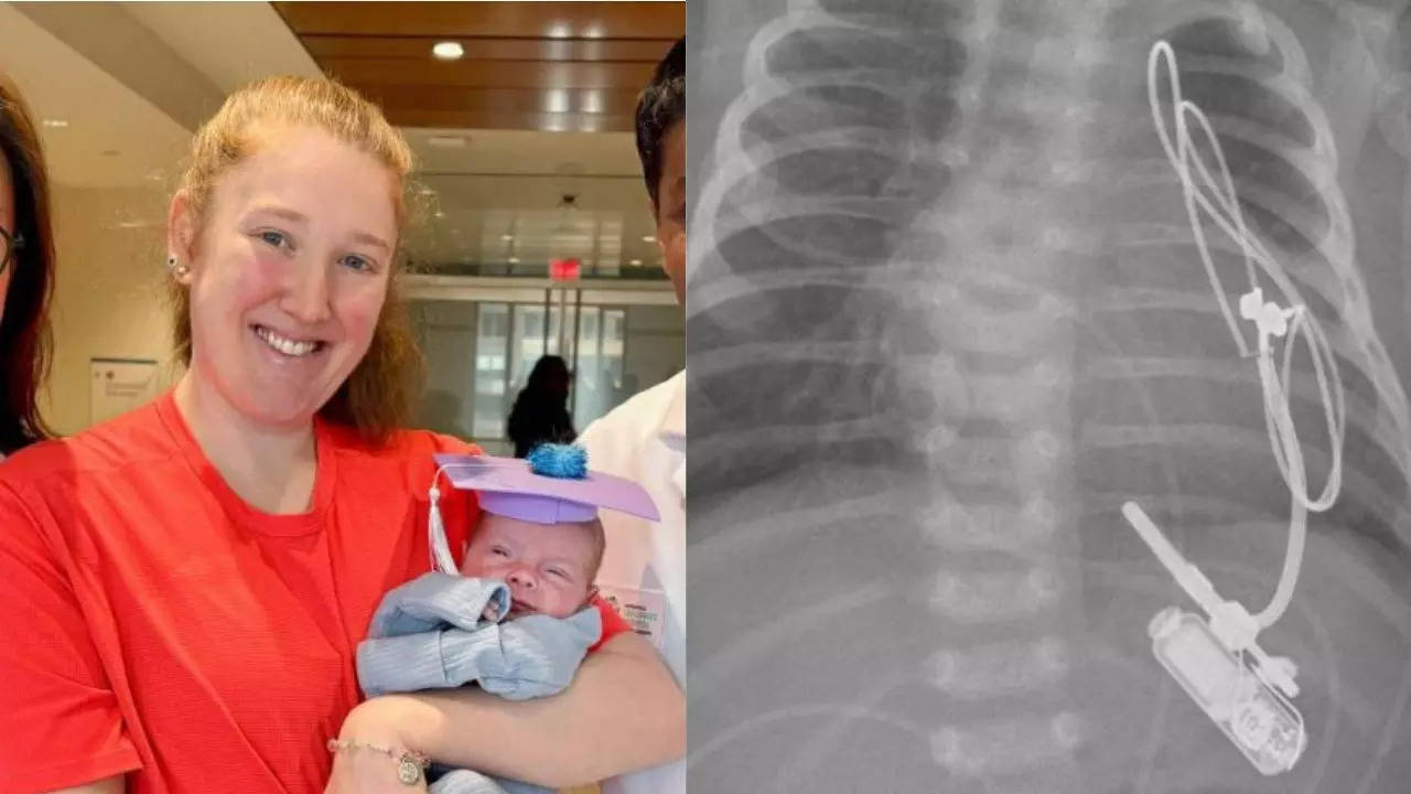 Baby Implanted With World's Smallest Pacemaker To Treat a Dangerous ...