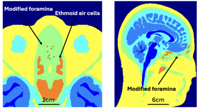 Noninvasive brain stimulation device can help treat depression, PTSD ...