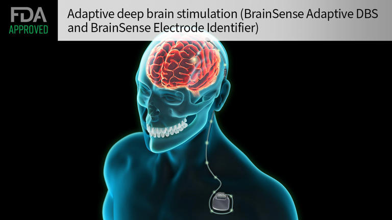 FDA Approves Adaptive Deep Brain Stimulator for Parkinson's Disease