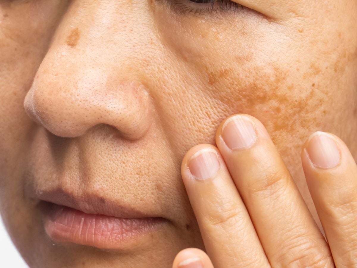 ¿Qué es el melasma (paño o cloasma)? Causas y síntomas