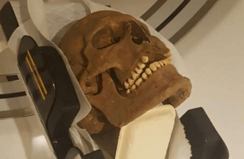 X-ray, CT scans reveal: Vikings battled some serious headaches, ear ...