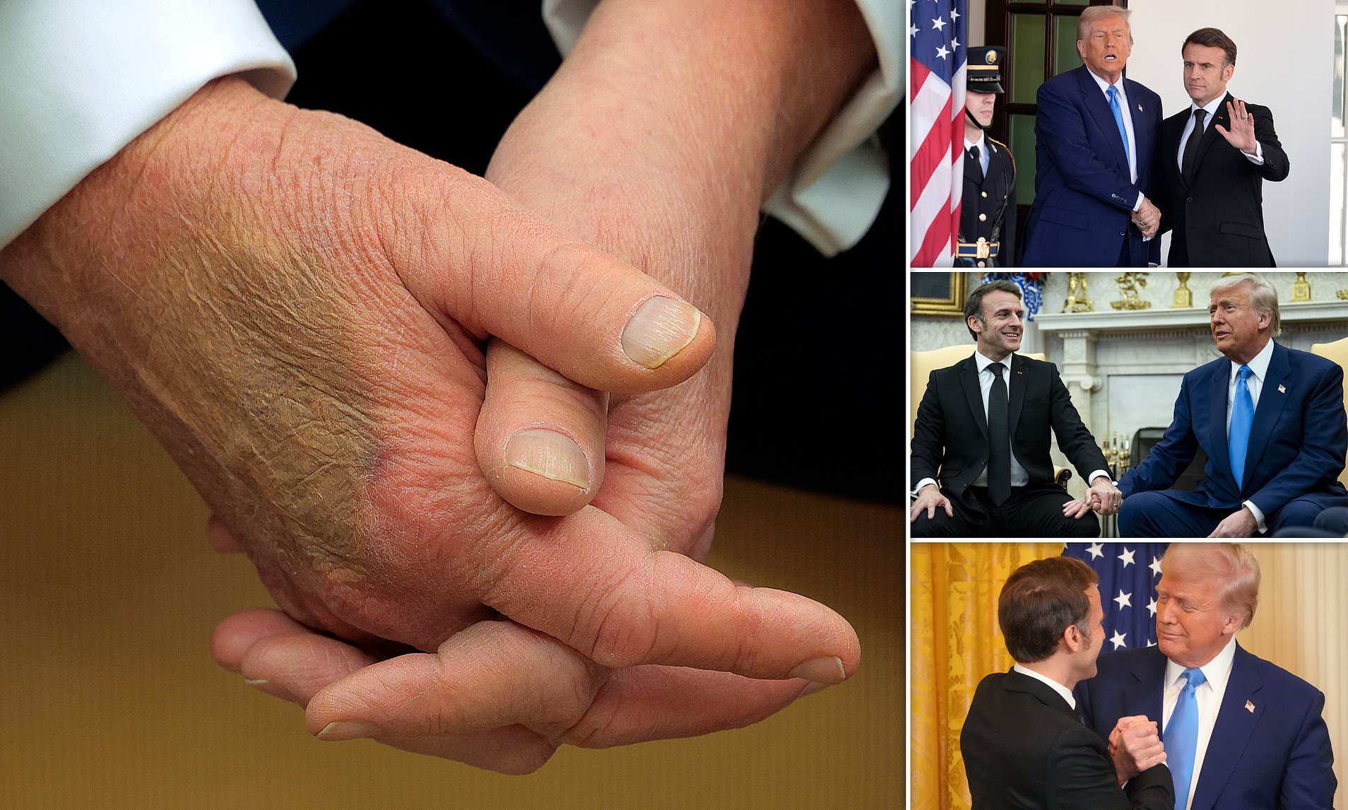 People speculate about bruise on Trump's hand after awkward handshakes