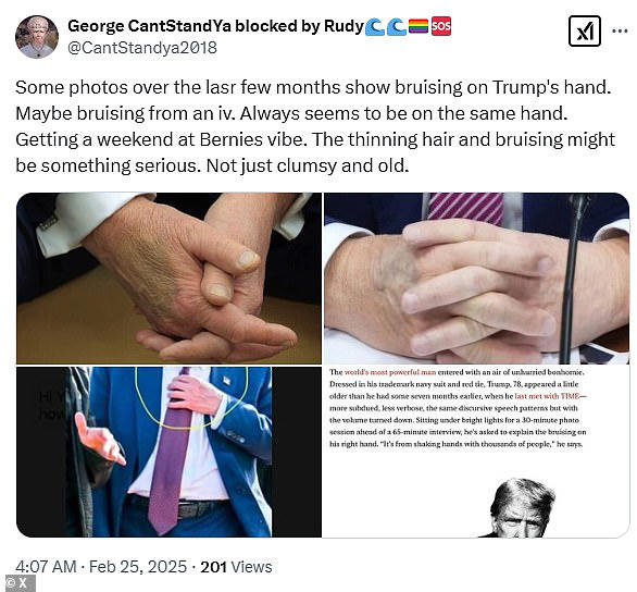 People speculate about bruise on Trump's hand after awkward handshakes