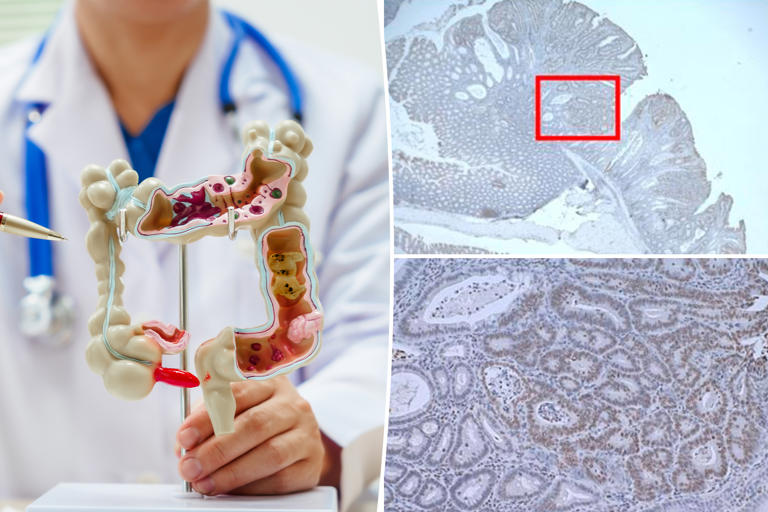 Scientists find ‘key’ that could be driving rising colon cancer rates