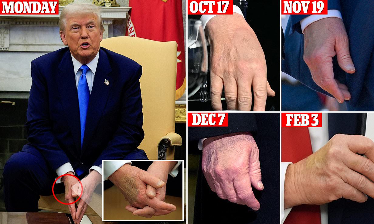 Truth behind Trump's mysteriously bruised hand