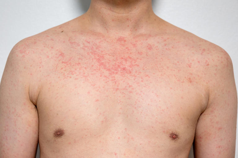 Texas measles outbreak officially surpasses 100 cases, mostly among ...