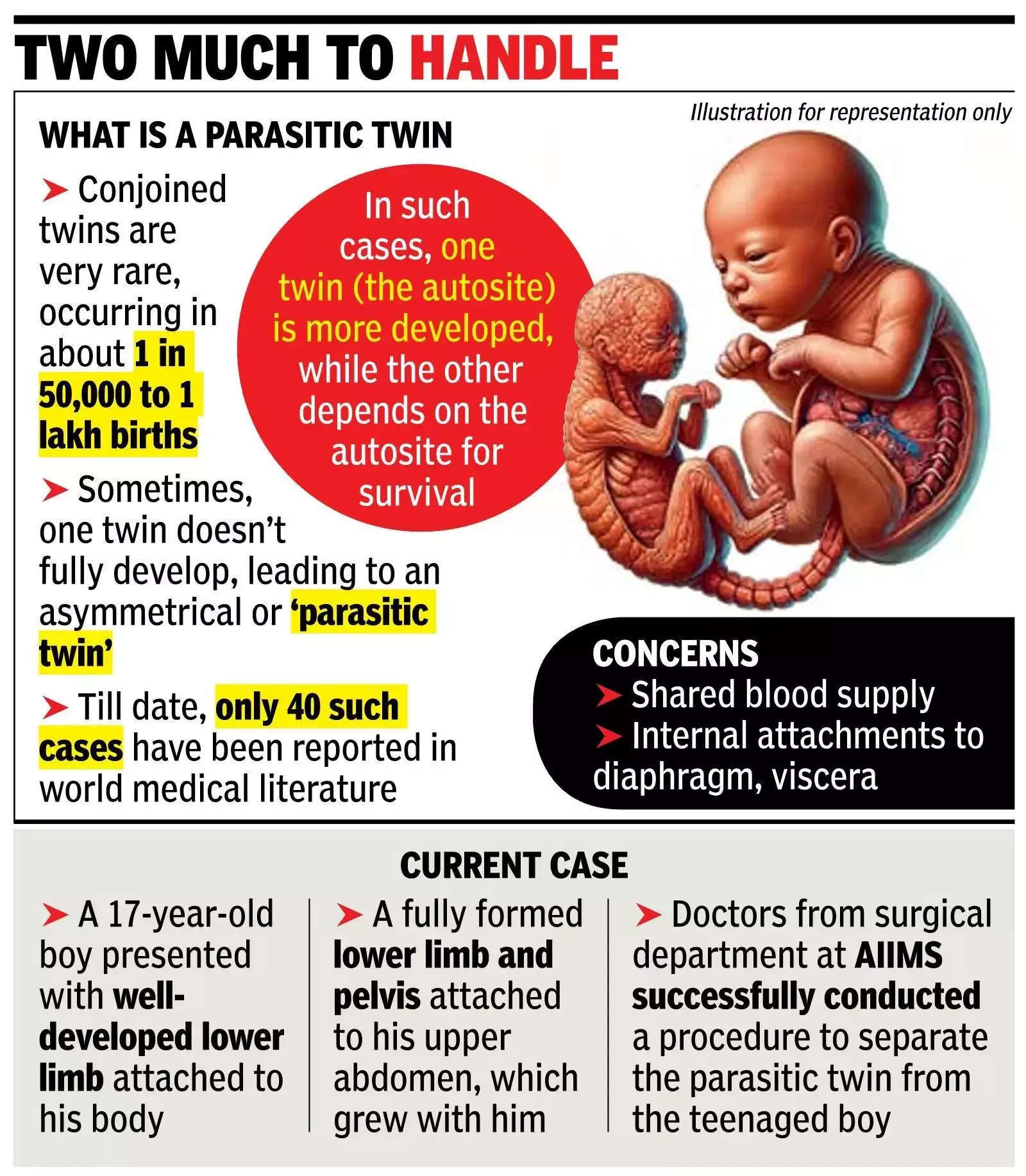 In rare surgery, docs separate ‘parasitic twin’ from 17-year-old