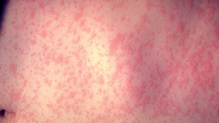 Texas measles outbreak grows to over 120 cases, DSHS reports