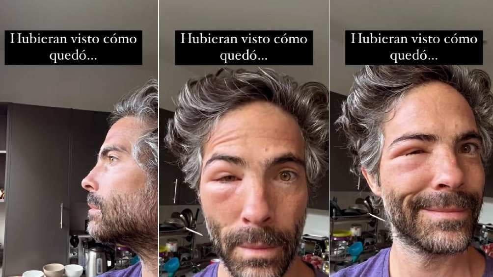 Actor Osvaldo Benavides aparece con el rostro desfigurado ¿Qué le pasó?