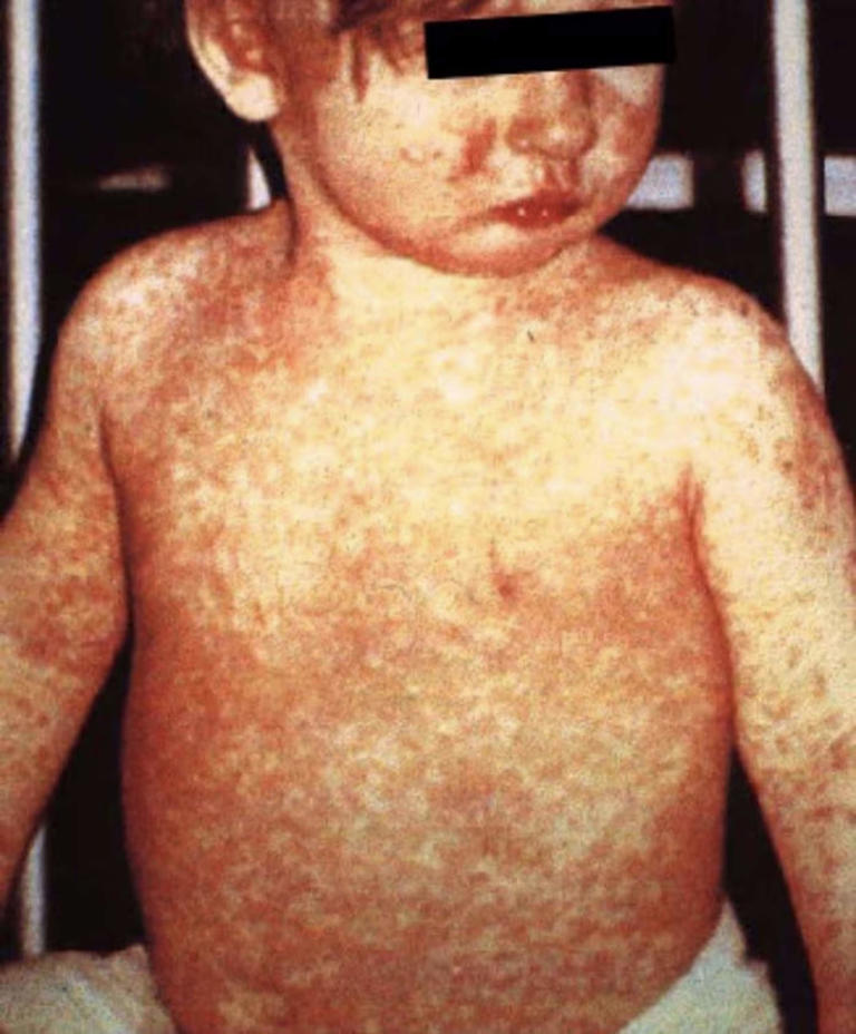 Unvaccinated child dies of measles in Texas outbreak: Know these ...