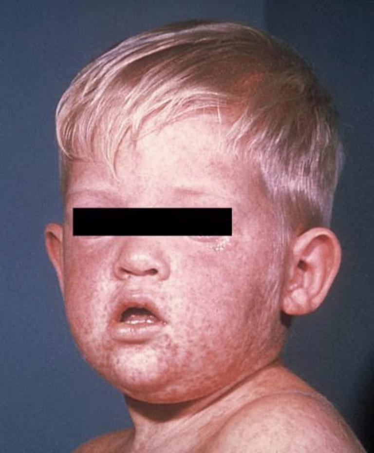 Unvaccinated child dies of measles in Texas outbreak: Know these ...