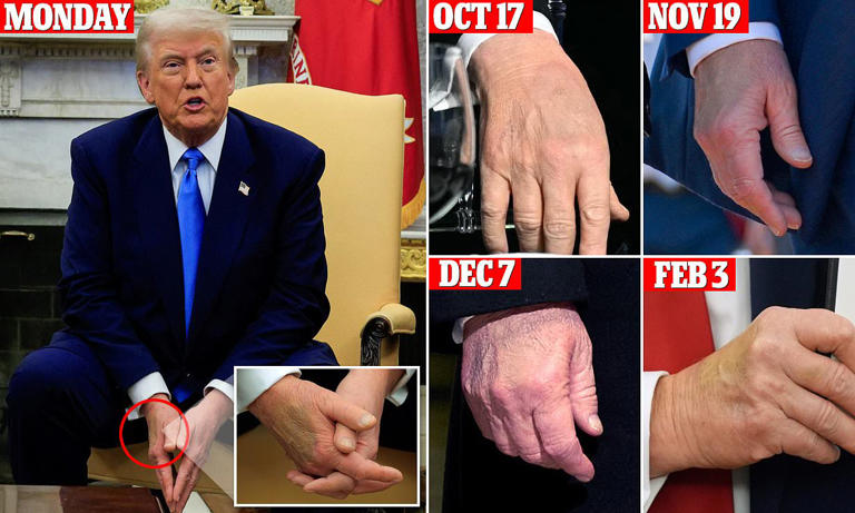 Truth behind Trump's mysteriously bruised hand Truth behind Trump's mysteriously bruised hand