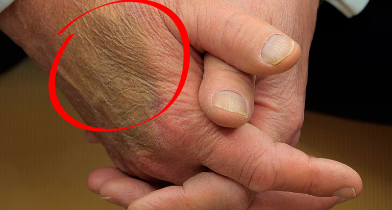 On sait pourquoi Trump a une blessure à la main droite