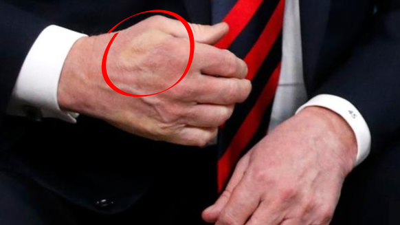 On sait pourquoi Trump a une blessure à la main droite