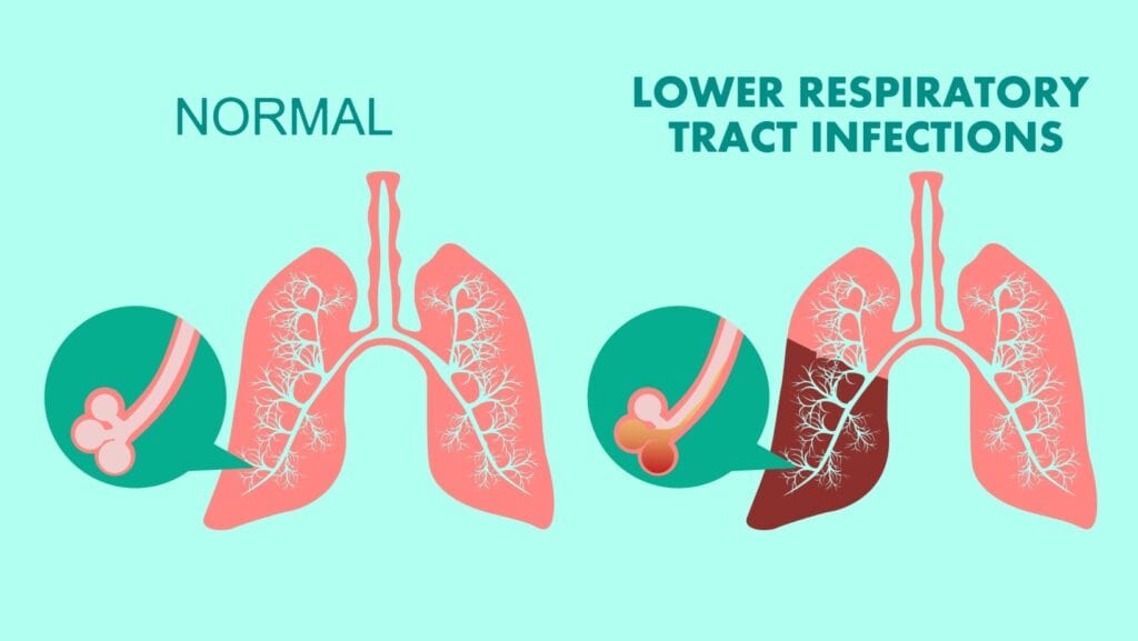 Are You at Risk for Chronic Lower Respiratory Disease? What You Need to ...