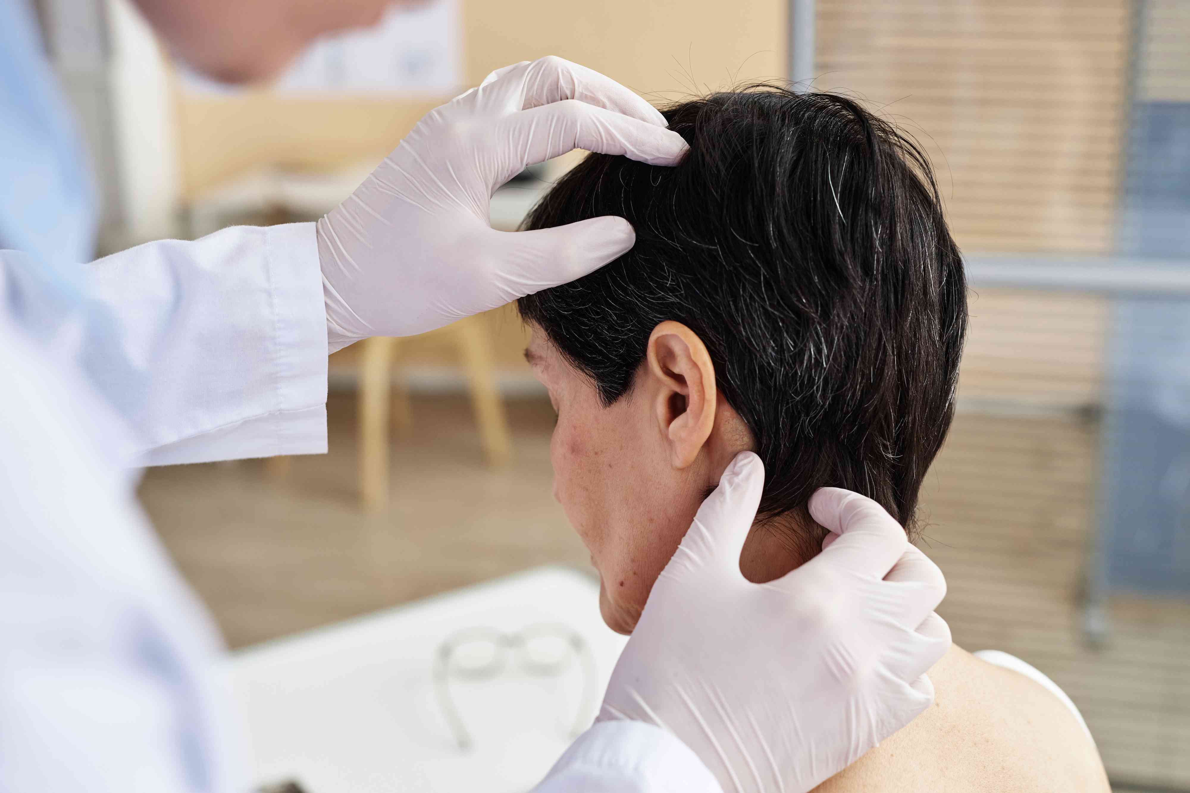 Scalp folliculitis symptoms and treatments