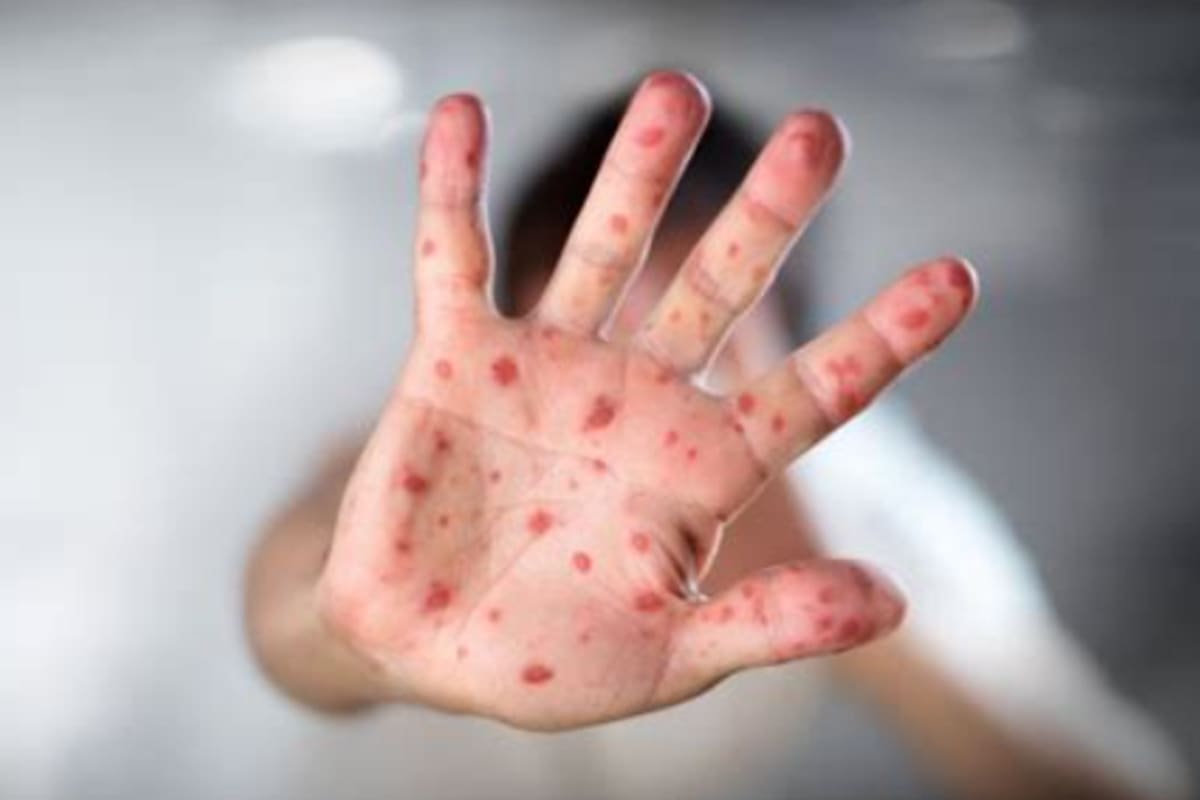Measles Outbreak In West Texas Claims First US Death In A Decade ...